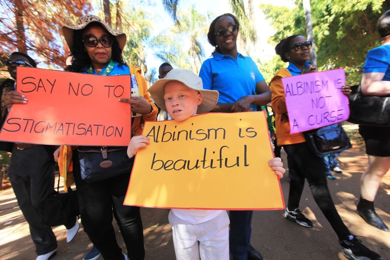 Albinos en Zimbabue describen una vida de exclusión social