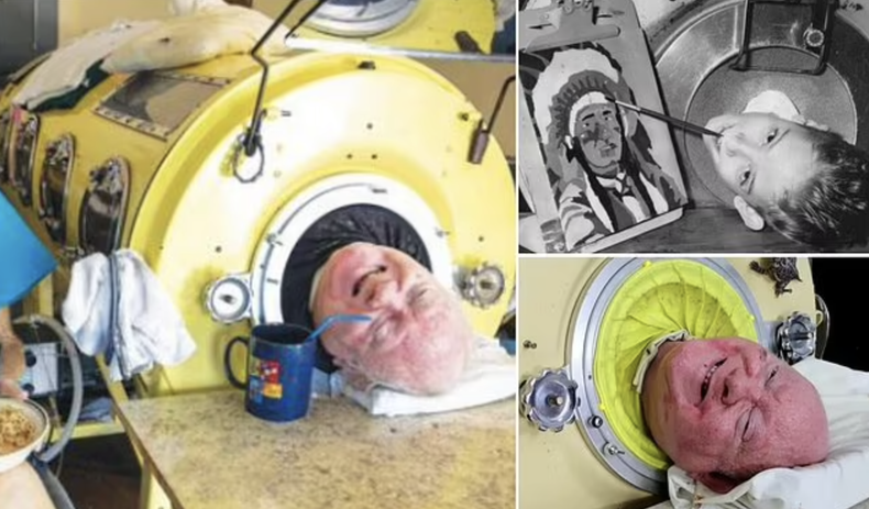 Murió a los 78 años Paul Alexander, el hombre que vivía en un pulmón de ...