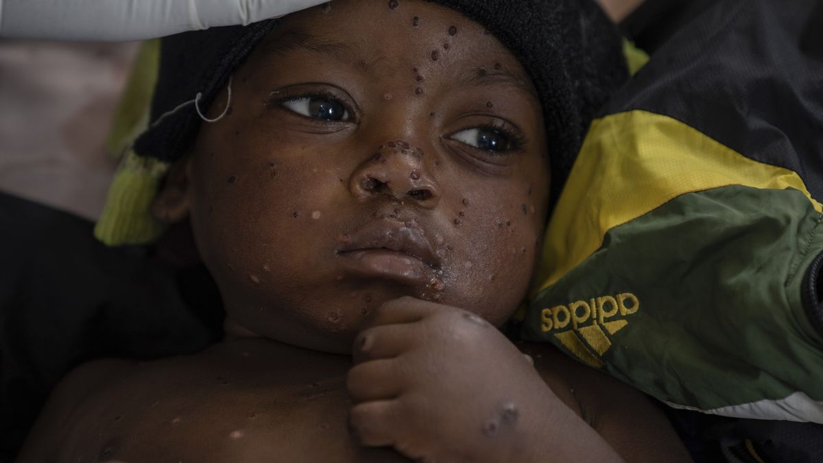 La ONU autoriza la primera vacuna infantil contra la viruela símica en ...